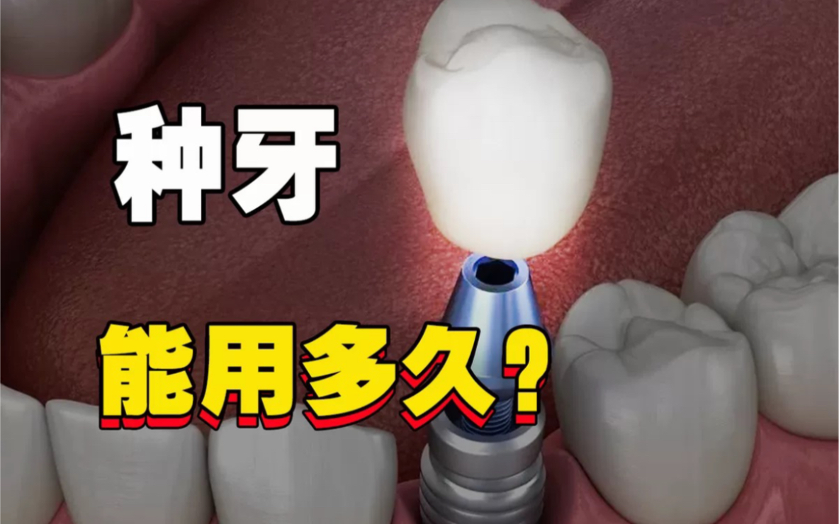 种牙那么贵,一颗能用多久?