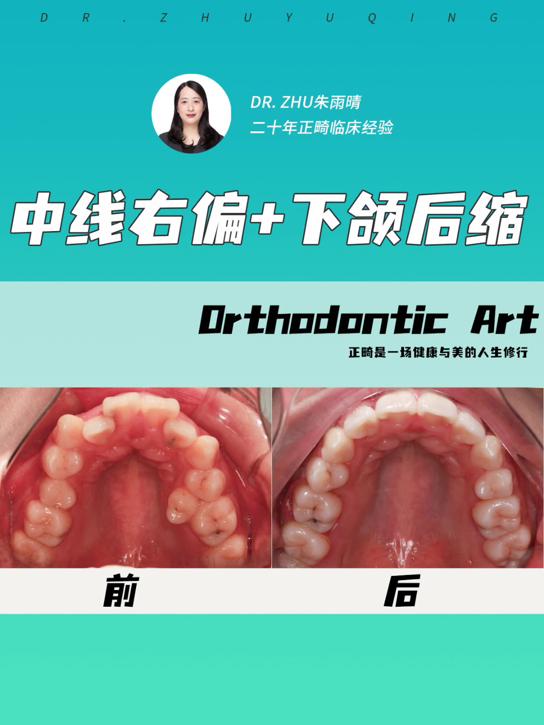 正畸案例分享90后女孩矫治后颜值飙升!——义乌傅氏口腔