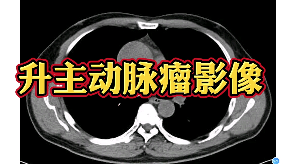 升主动脉瘤在CT上什么表现?诊断标准是什么?医生讲解!
