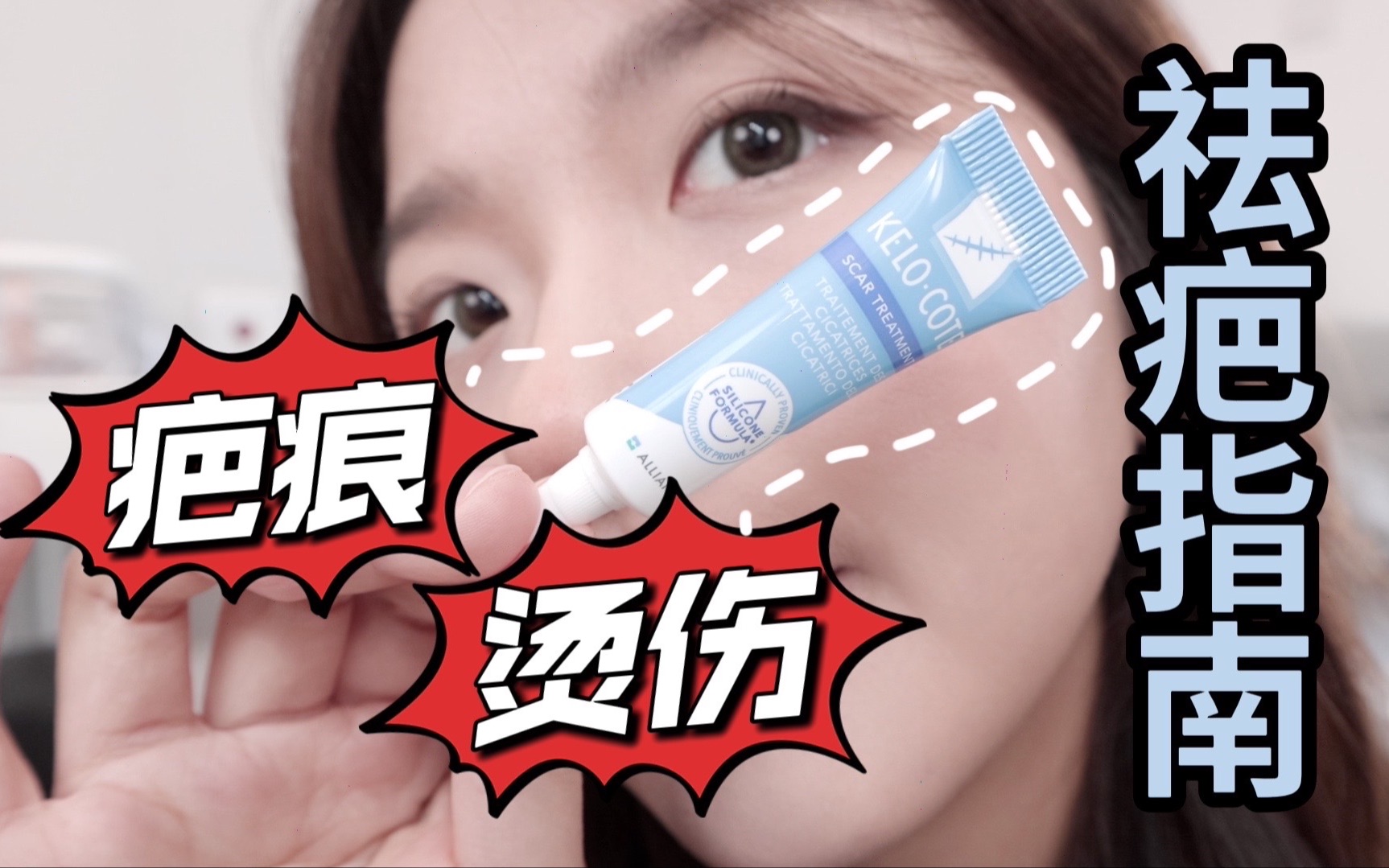 疤痕还能修复吗?无疤痕无增生真实祛疤分享!