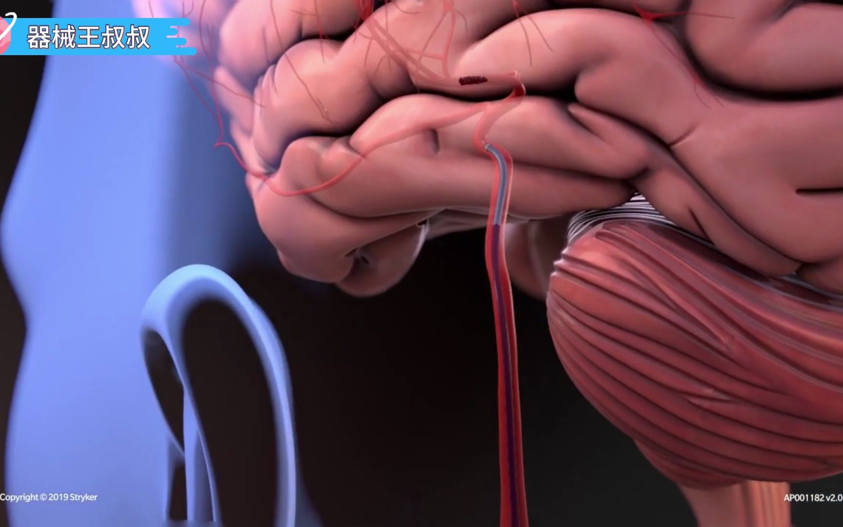 脑梗后,介入微创脑血栓取出术,3D演示 #脑梗 #TRAP技术 #中风 #机械...