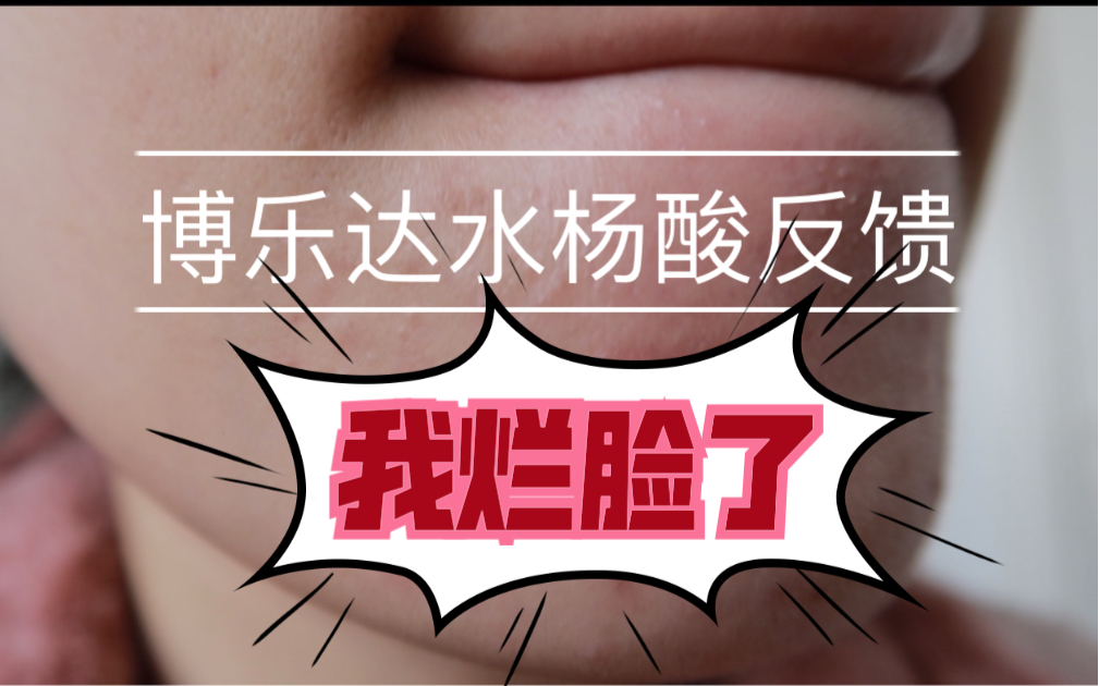 刷酸|全网吹的博乐达水杨酸,在我脸上烂!脸!了!(10.23-11.30使用反馈)
