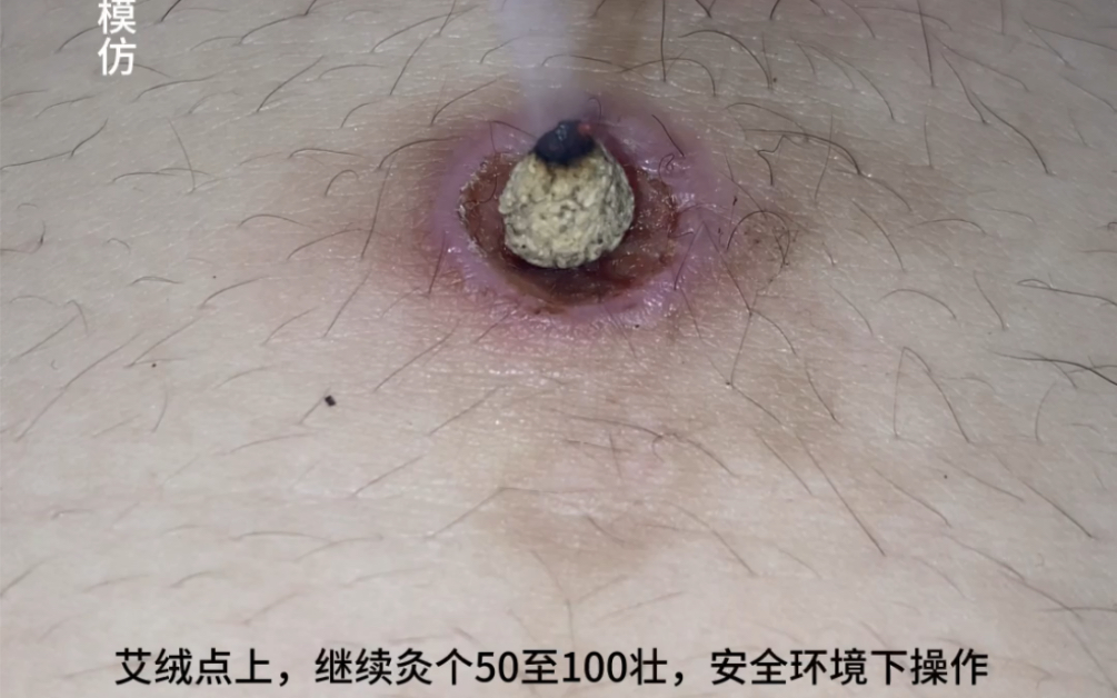 关元穴脱落黑痂后,继续施灸至结丹