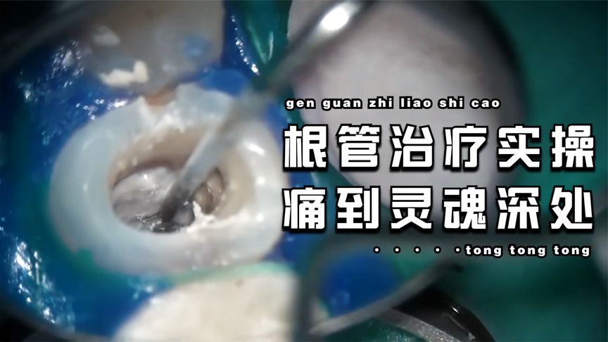 根管治疗的实操视频!痛到灵魂深处(bgm很好听哦~)