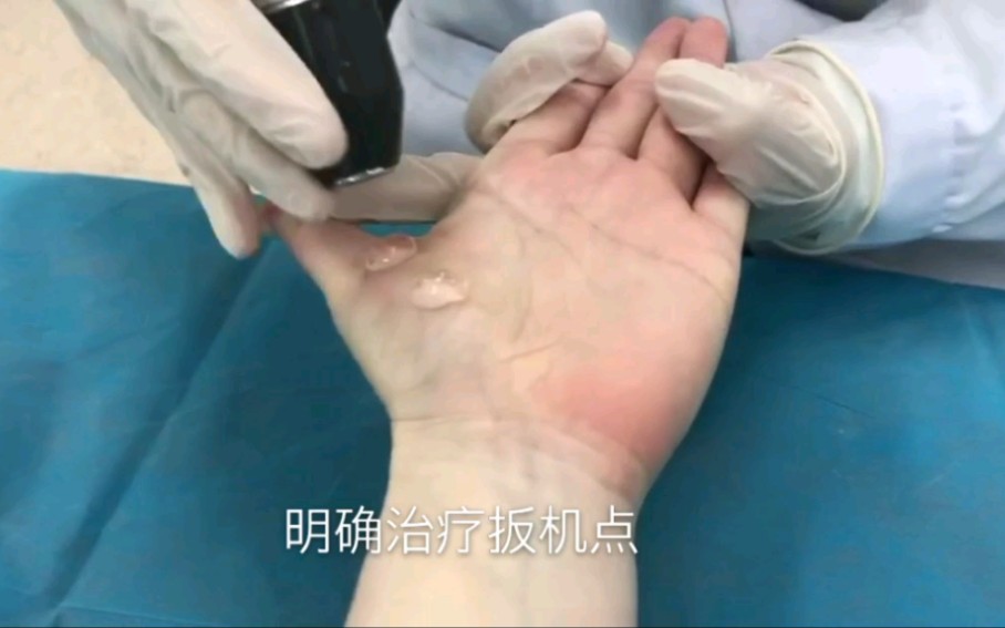 拇指腱鞘炎的冲击波治疗!