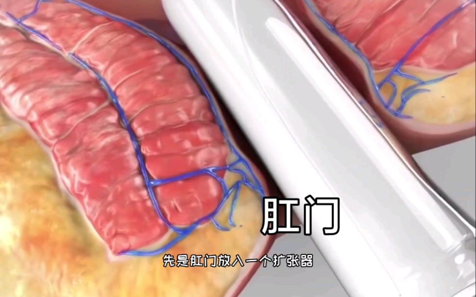 激光治痔疮过程,3D演示。