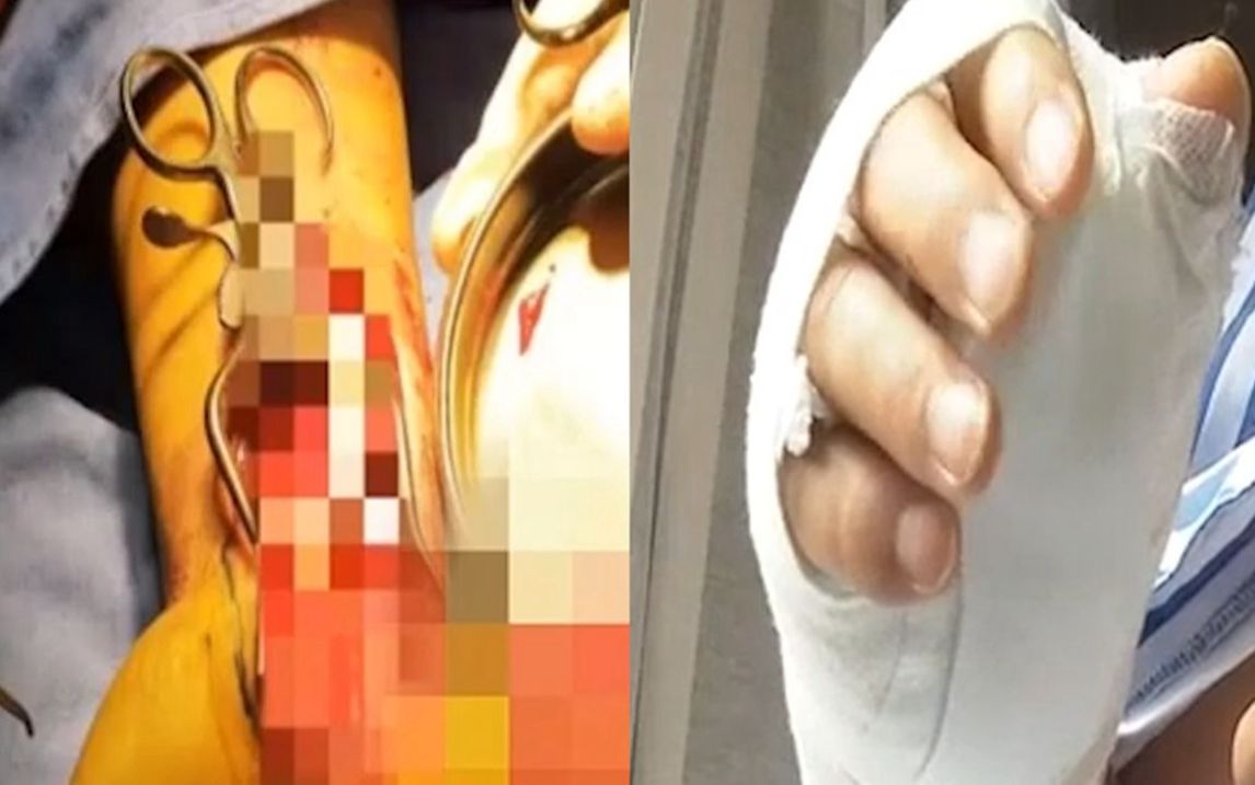 男子手指被小黄鱼刺扎伤,2个月后疼得就医切25公分伤口,差点截肢