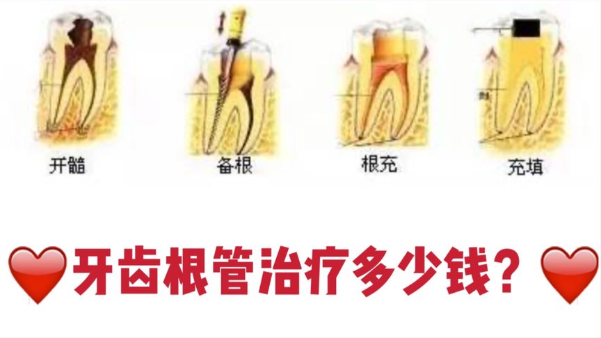 牙齿根管治疗多少钱一颗?为什么每颗牙齿收费不一样