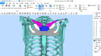 肺结节穿刺导板3d打印模型