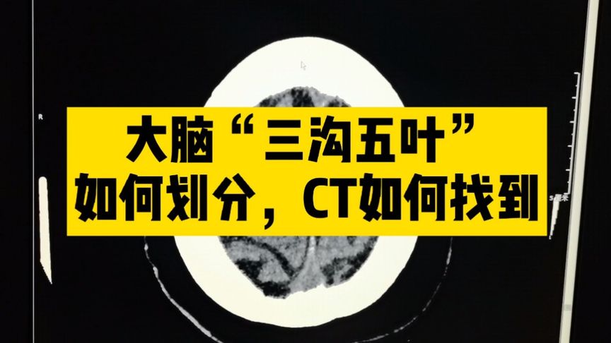 头颅CT“三沟五叶”如何划分,如何在断层上找到,并准确定位病灶