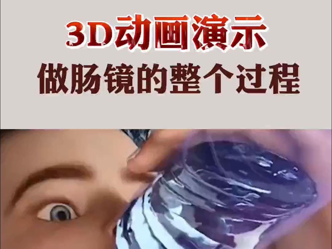 3D动画演示,肠镜怎么做的