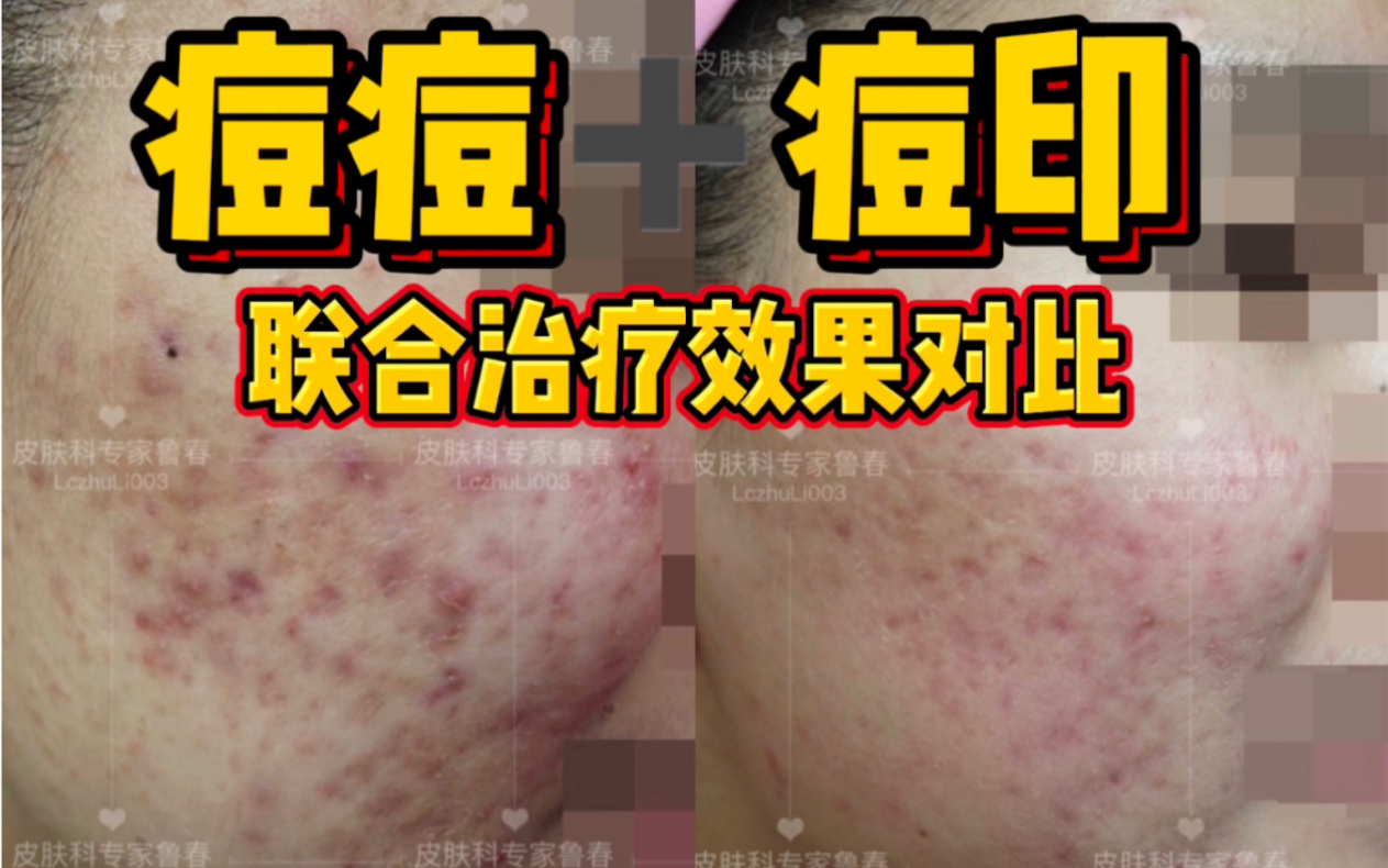 炎症痘痘+痘印黄金微针联合治疗后的皮肤对比