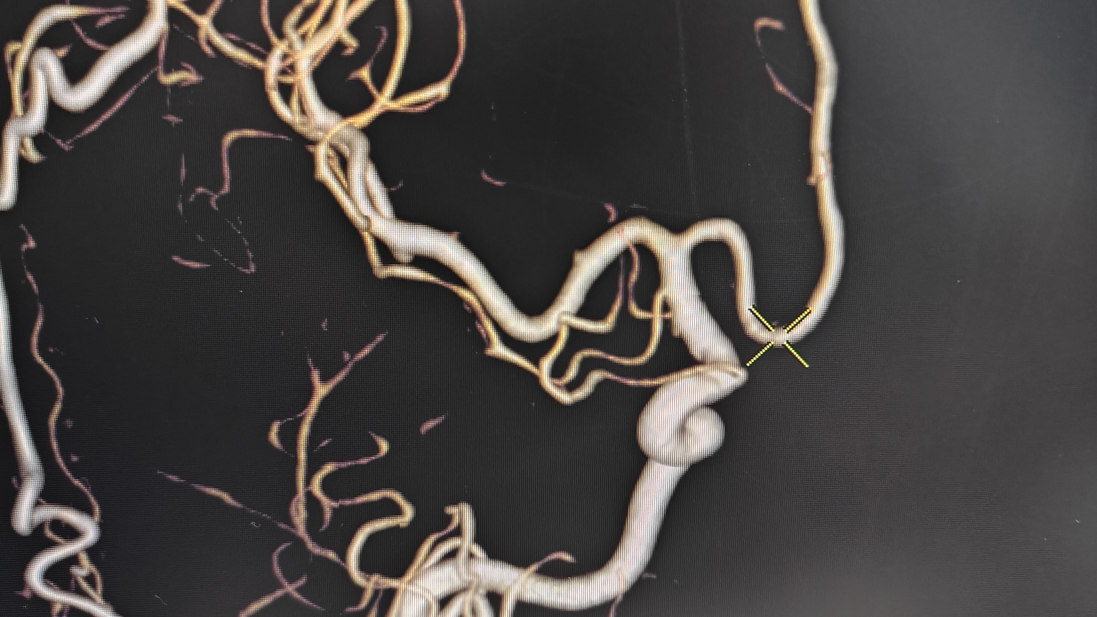 全脑血管造影(DSA)显示副大脑中动脉