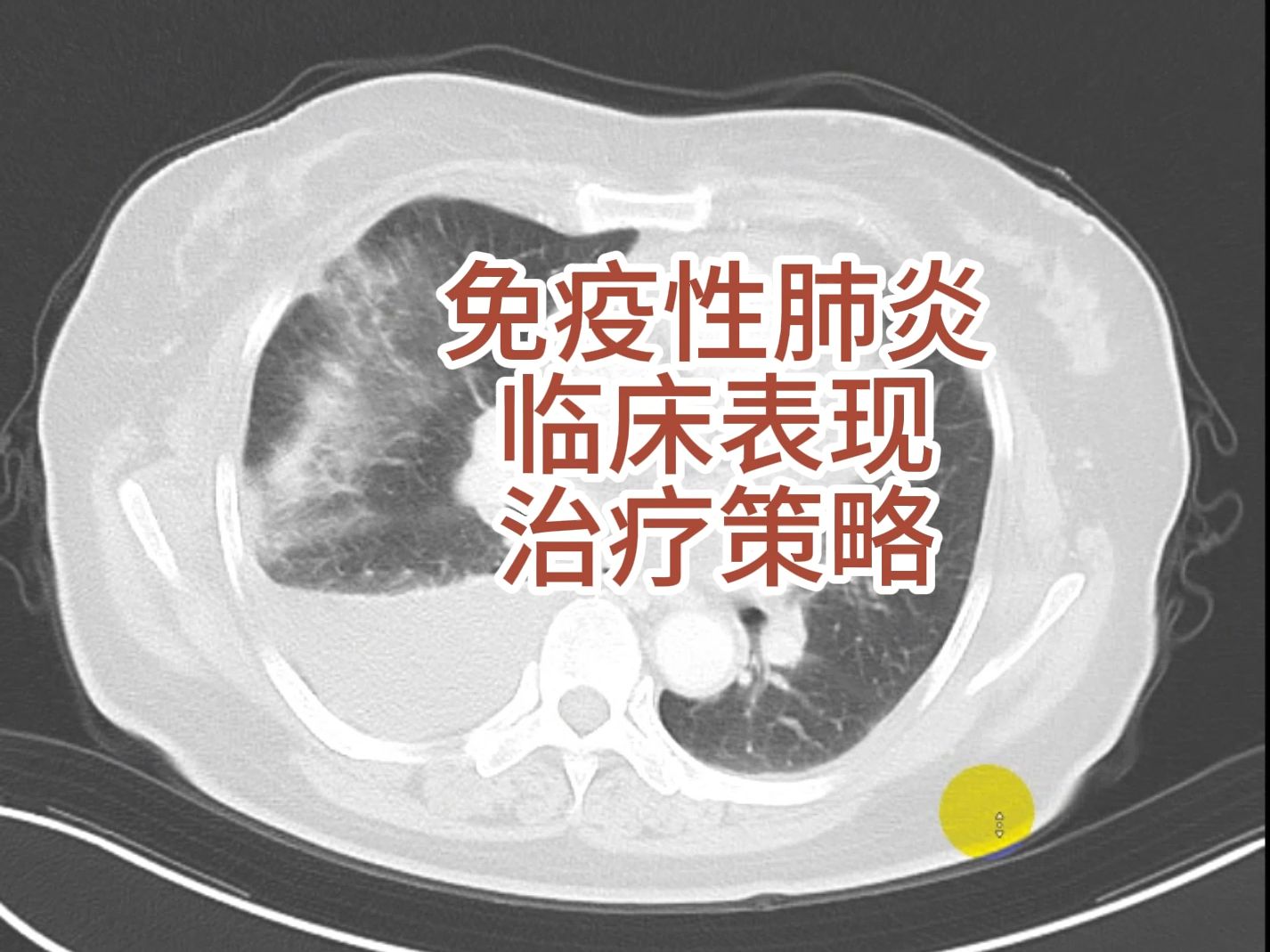 免疫性肺炎临床表现和治疗原则