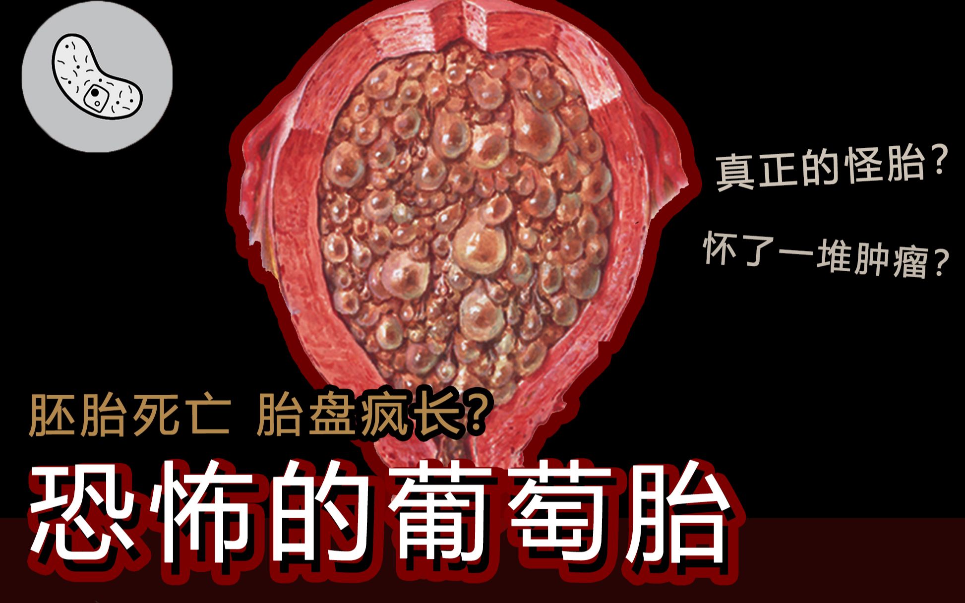 【恐怖的葡萄胎】孩子死了把胎盘养大了?大肚妈妈竟怀了一堆肿瘤!?...