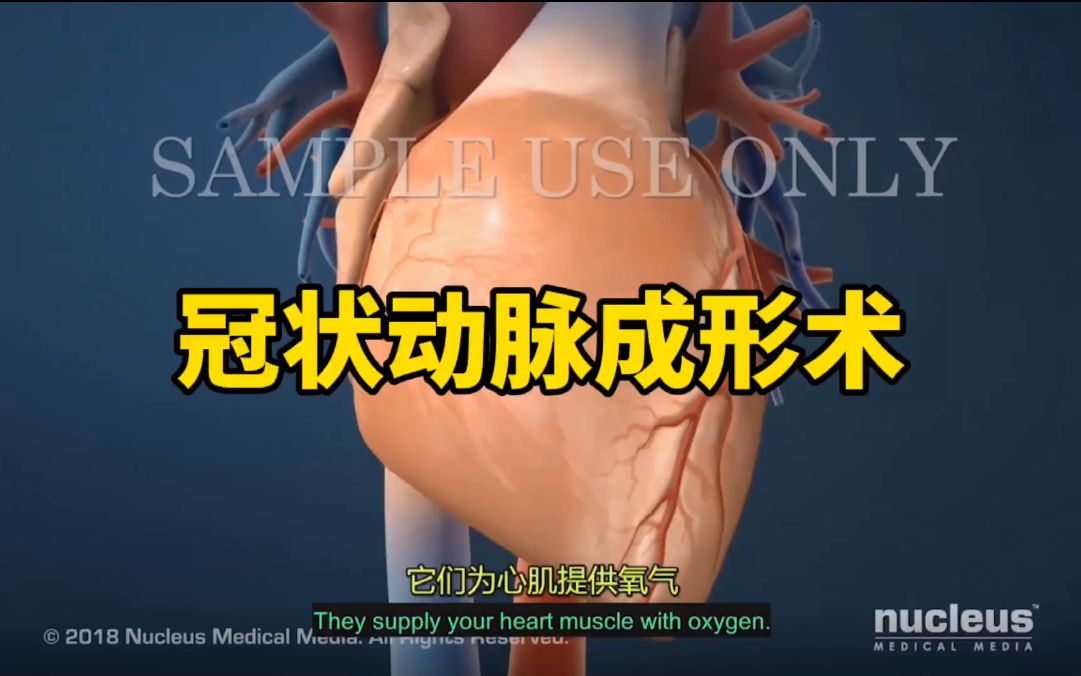 【3D医学动画】冠状动脉成形术