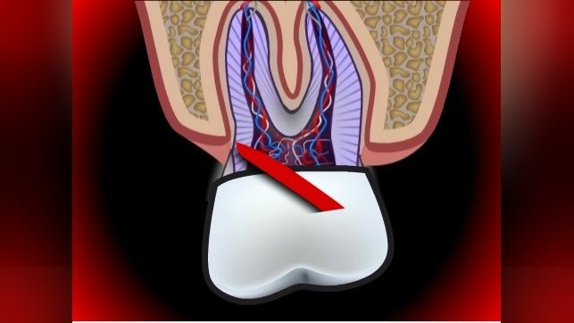 口腔修复学系列教程——桩冠4root pin