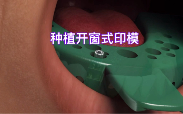 种植开窗式印模动画演示by BioHorizons#种植牙#取模#牙匠之家