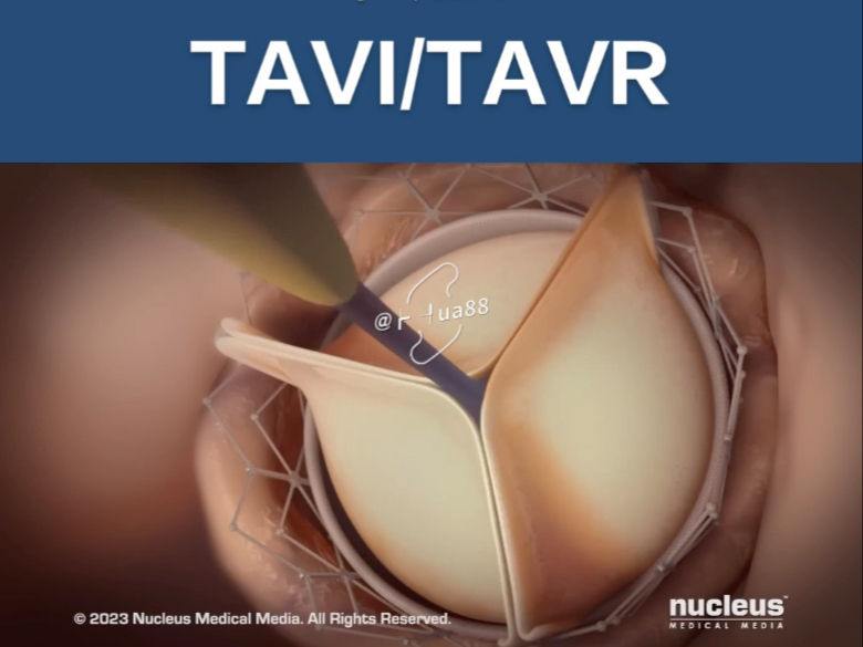 经导管主动脉瓣置换术(TAVI)