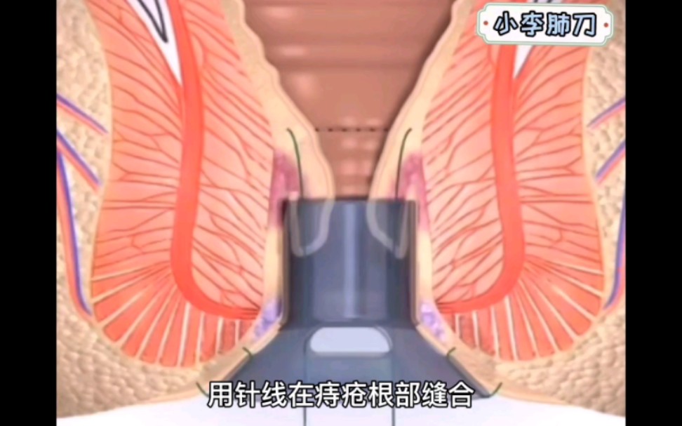 痔疮手术治疗过程,3D演示。