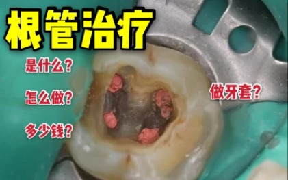 【某医】让人牙疼腿软的根管治疗到底是什么?要不要做?怎么做?多少...