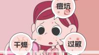 优思悦治痤疮动画科普短片