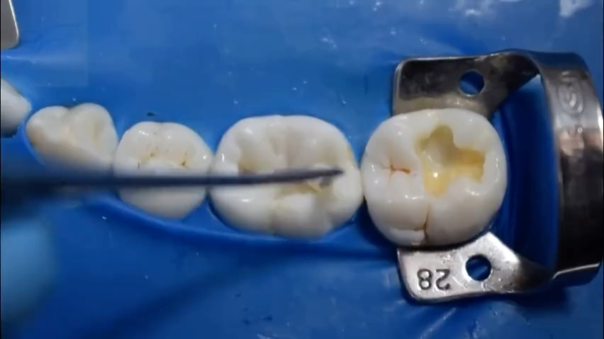 牙齿根管治疗的过程。龋坏太深侵入牙髓,我们就需要做根管治疗来...