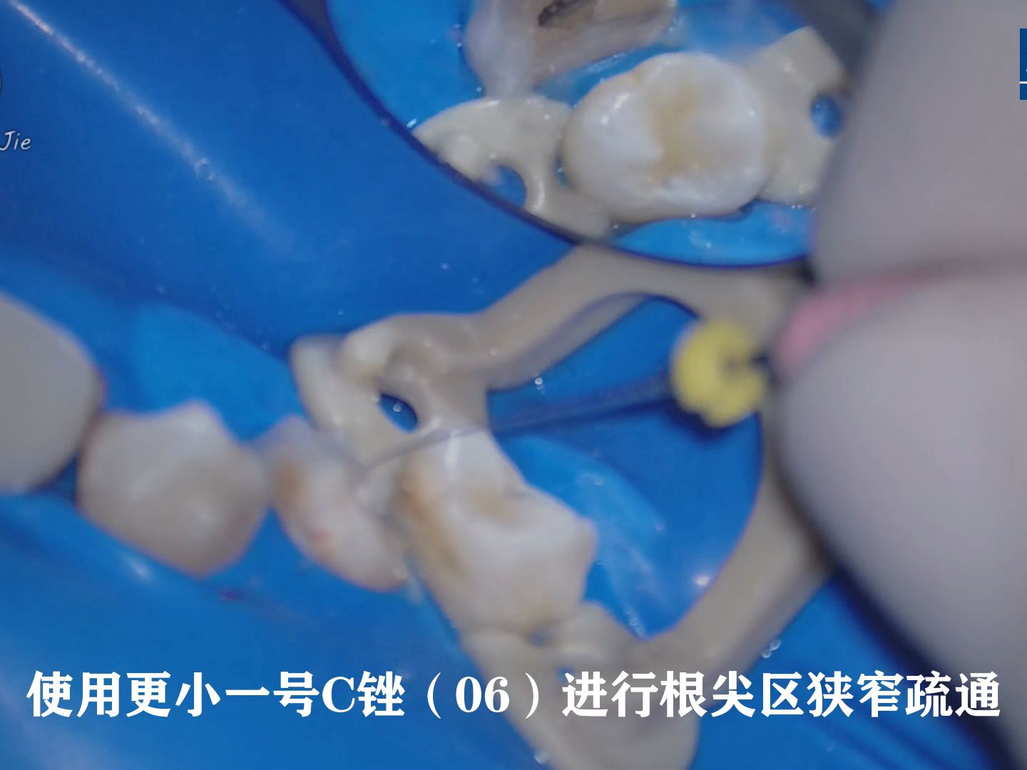 显微镜一次性根管治疗