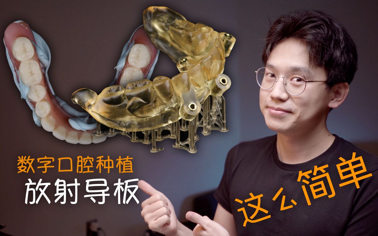 原来数字化口腔种植放射导板这么简单