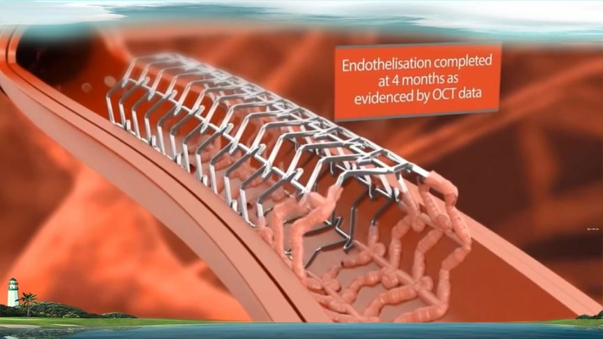 了解血管支架的工作原理