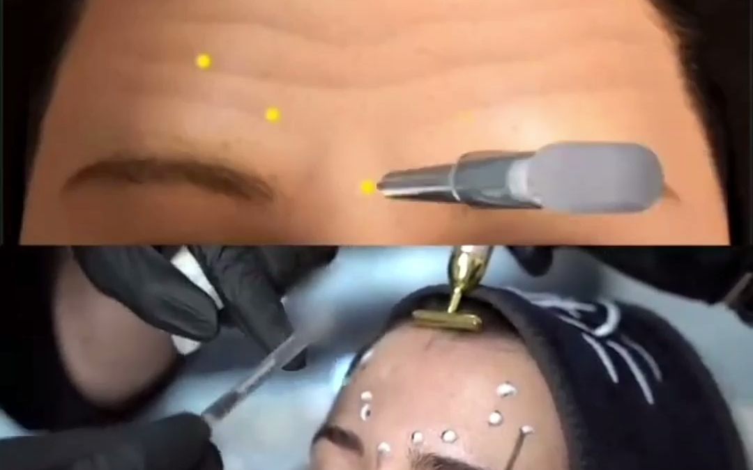 实拍肉毒素,让你的法令纹消失