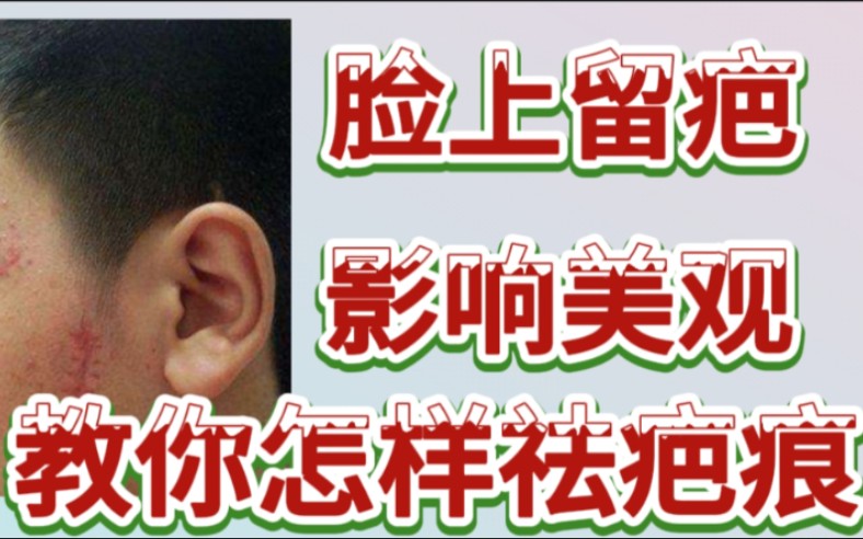 脸上有了疤痕,影响皮肤美观,怎样才能祛除疤痕?