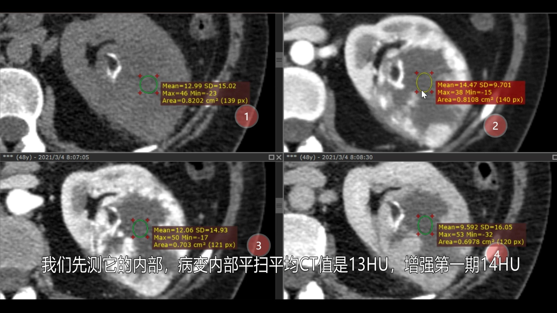 CT入门教学(15):增强CT判读中,如何判断组织有无强化?具体强化程度...