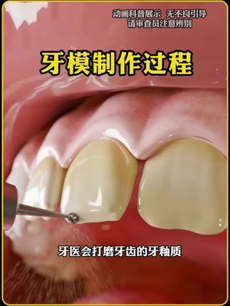 牙模制作过程
