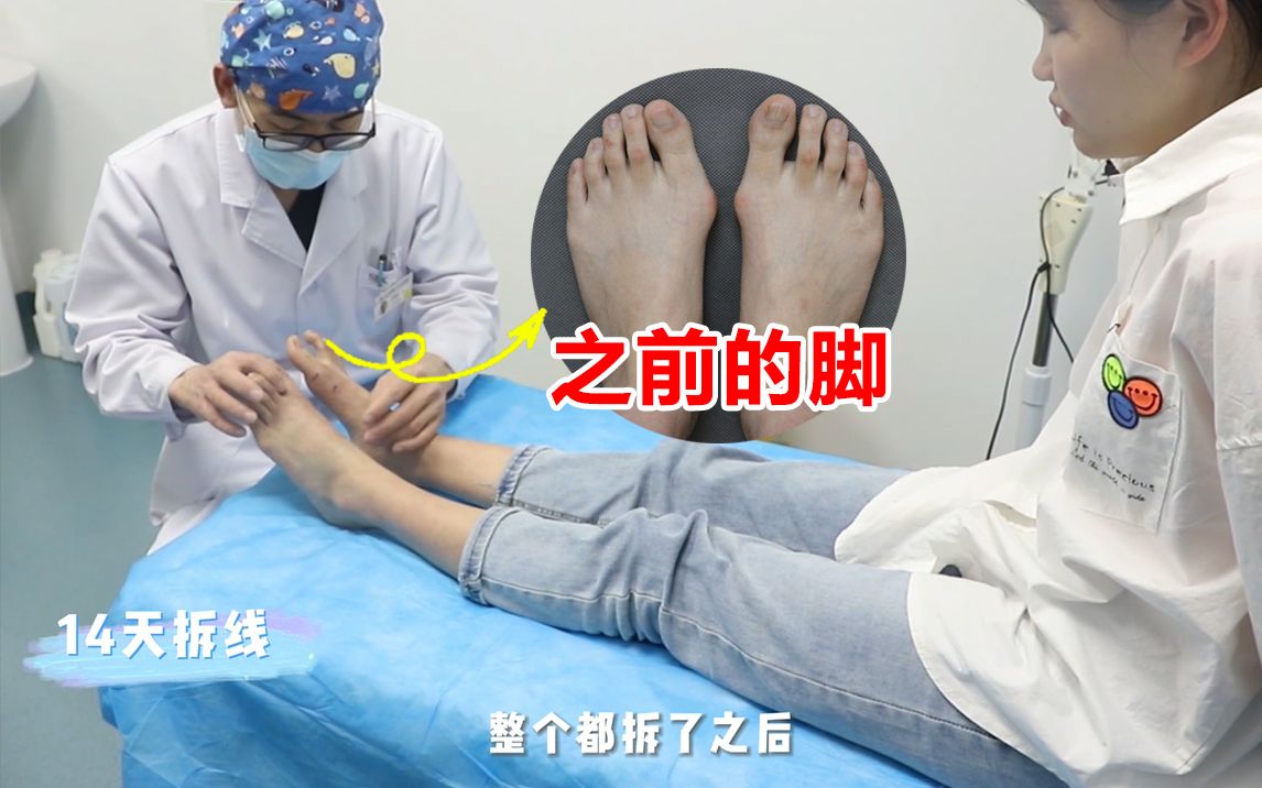 大脚骨医生苏敬达|拇外翻手术真不影响脚趾灵活度?姑娘术后四个月