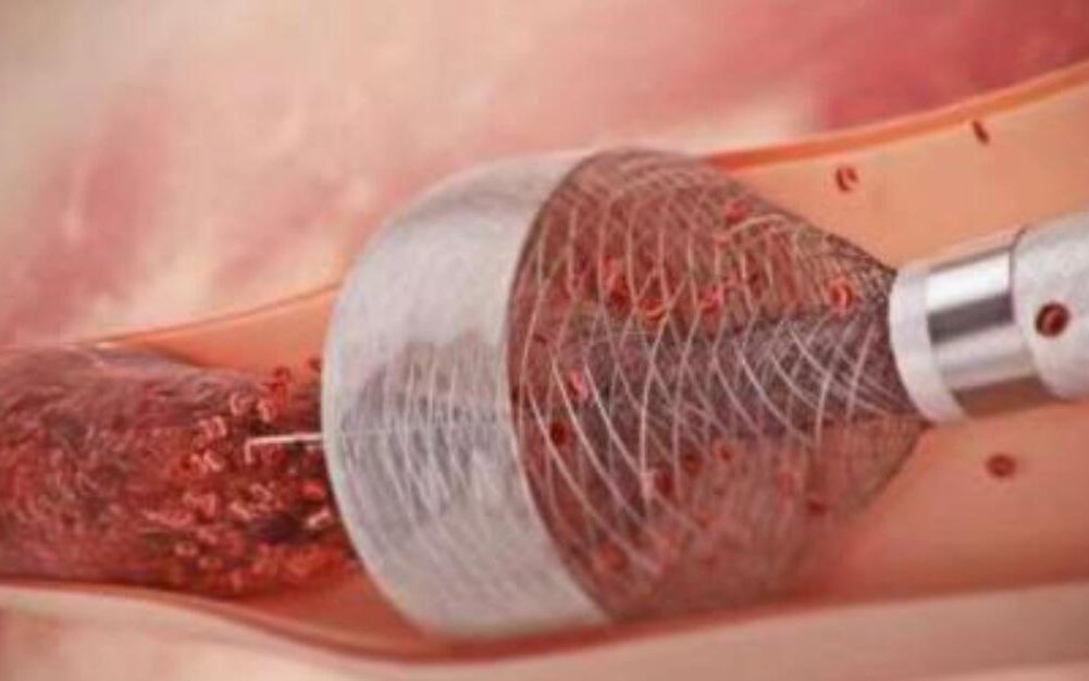 老外发明“血栓切除术系统”,两分钟内清除血栓,国内何时普及?