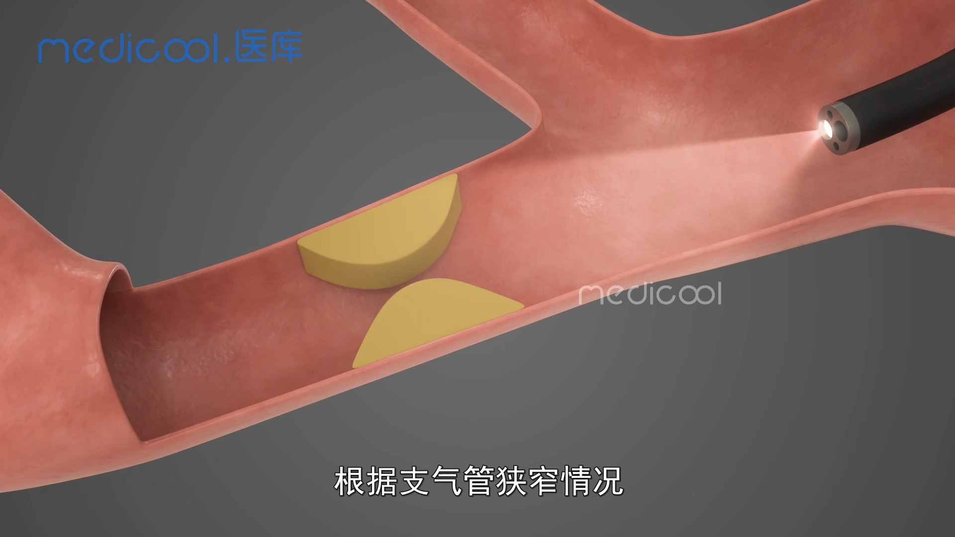 支气管镜介入球囊扩张手术