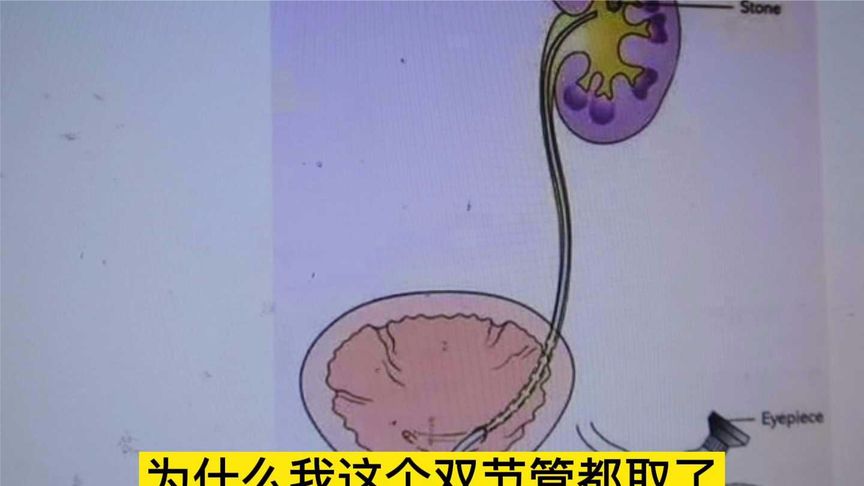 为什么双J管取出了还是排尿不爽