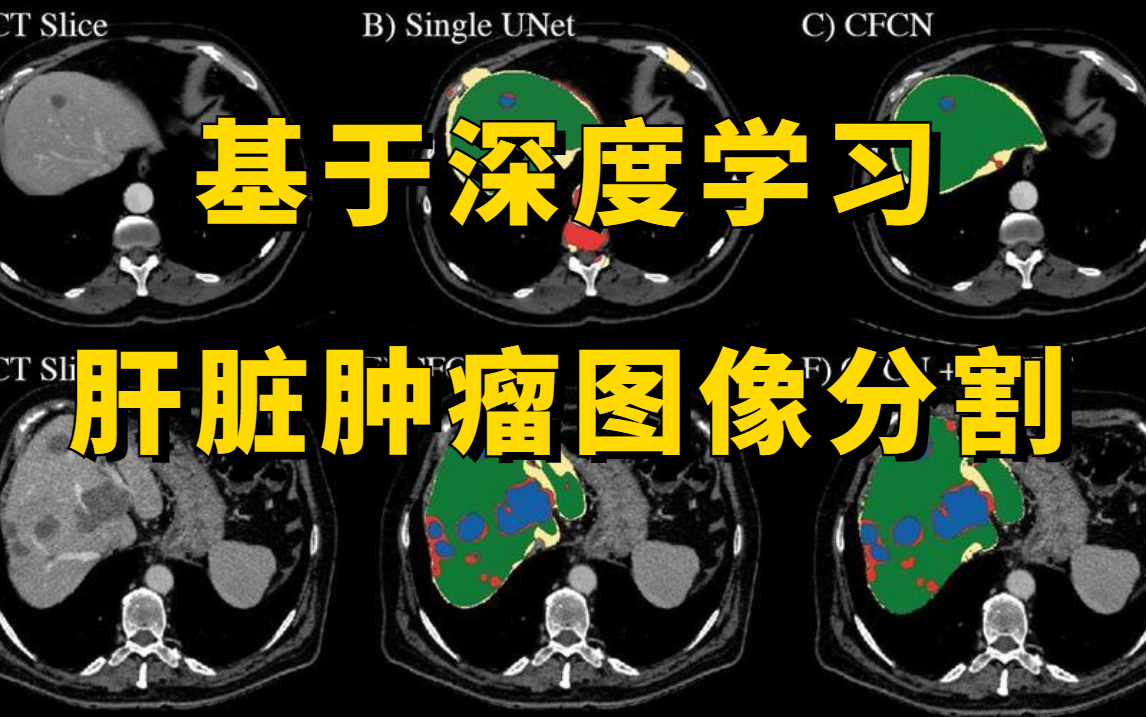 ...【医学图像处理实战教程】基于深度学习实现肝脏肿瘤图像分割,从环...