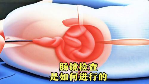 肠镜检查是如何进行的,动画还原全过程