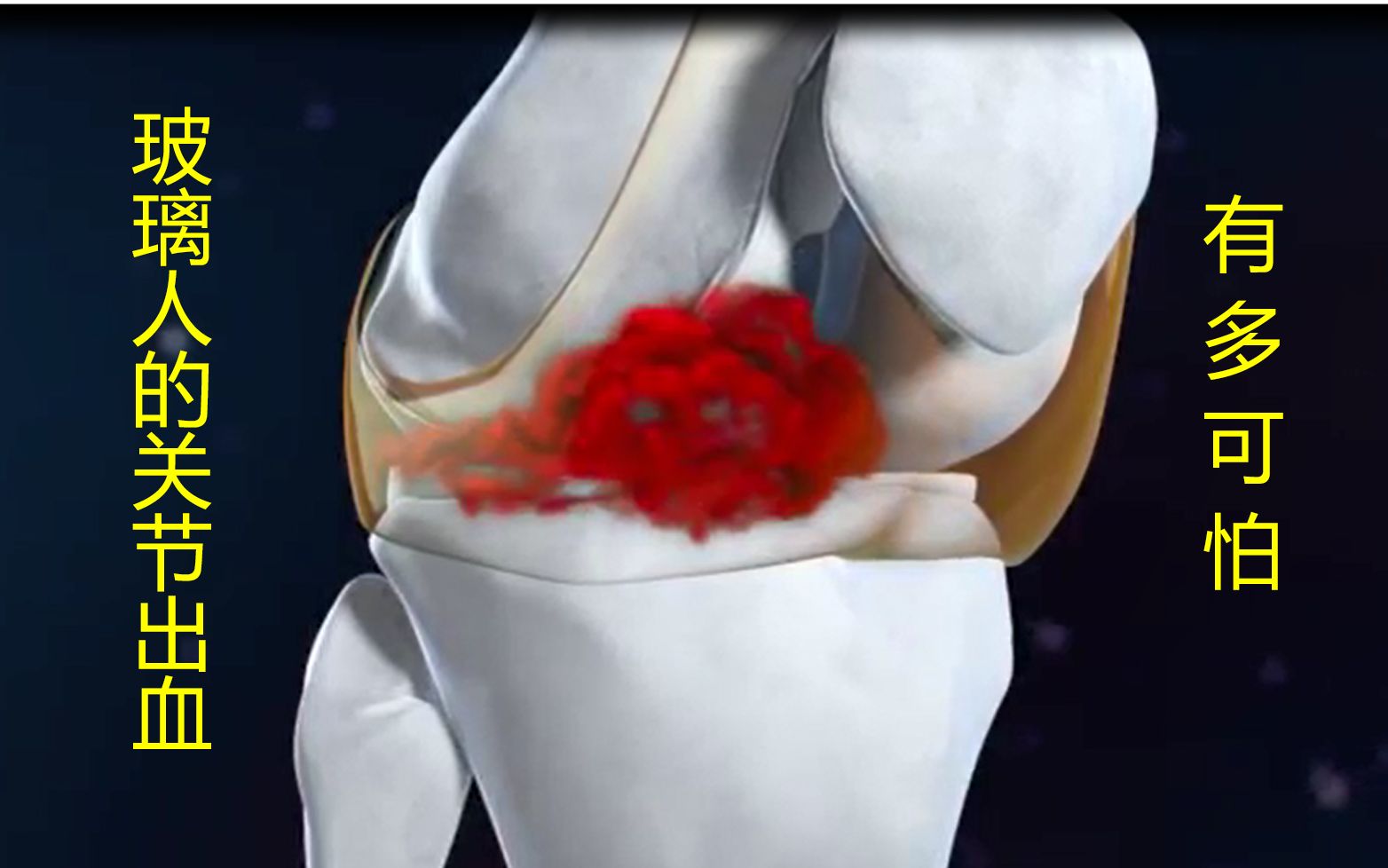 “玻璃人”的关节出血有多可怕——中英文字幕版