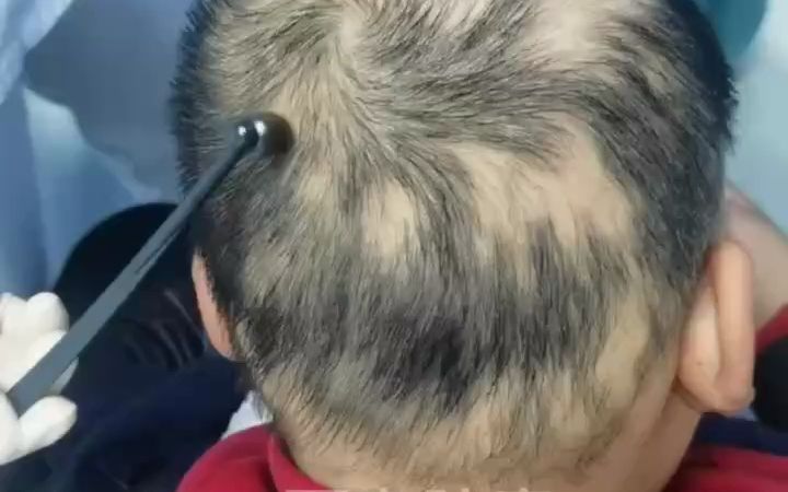 西安肤康脱发 梅花针扣刺治疗斑秃
