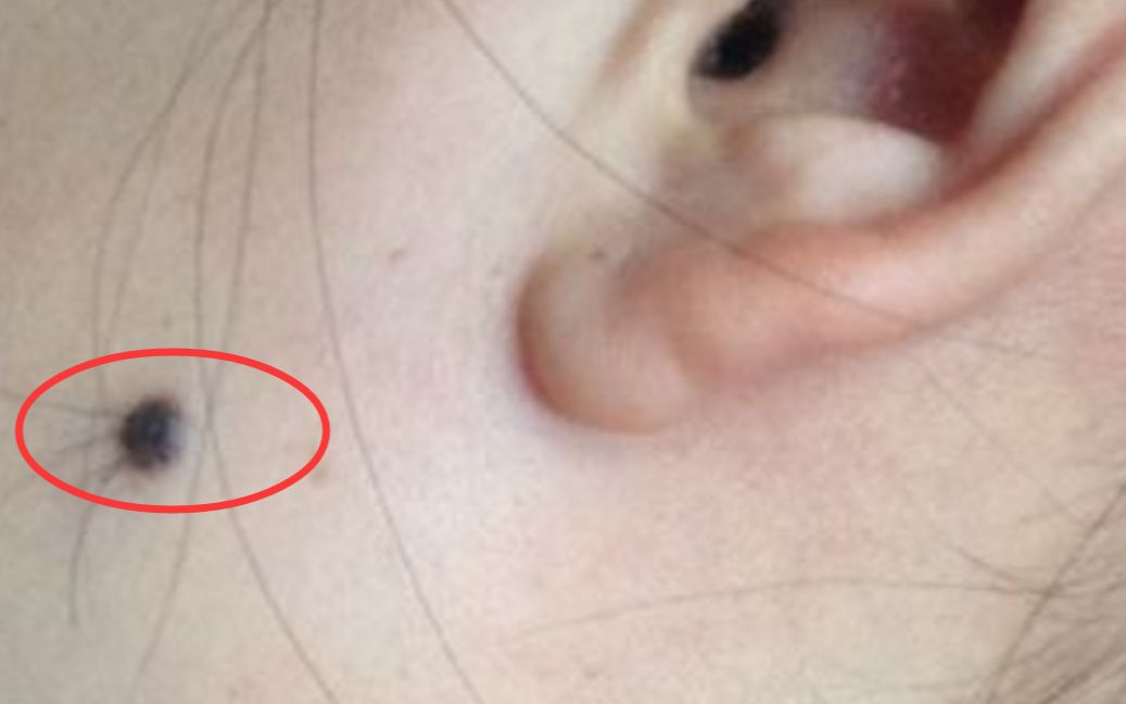 脸上有黑痣难看不敢出门,教你个土方法,快速消除黑痣