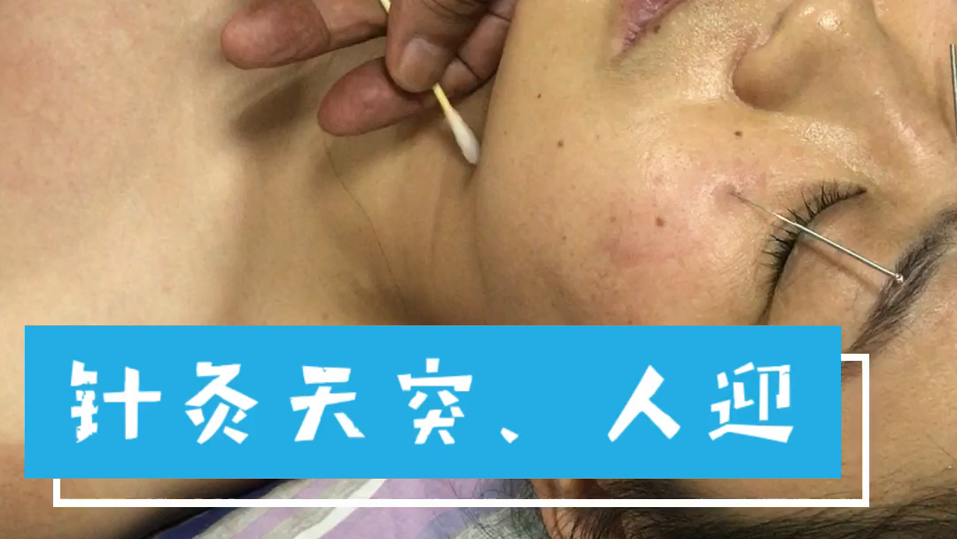 最具技术的进针