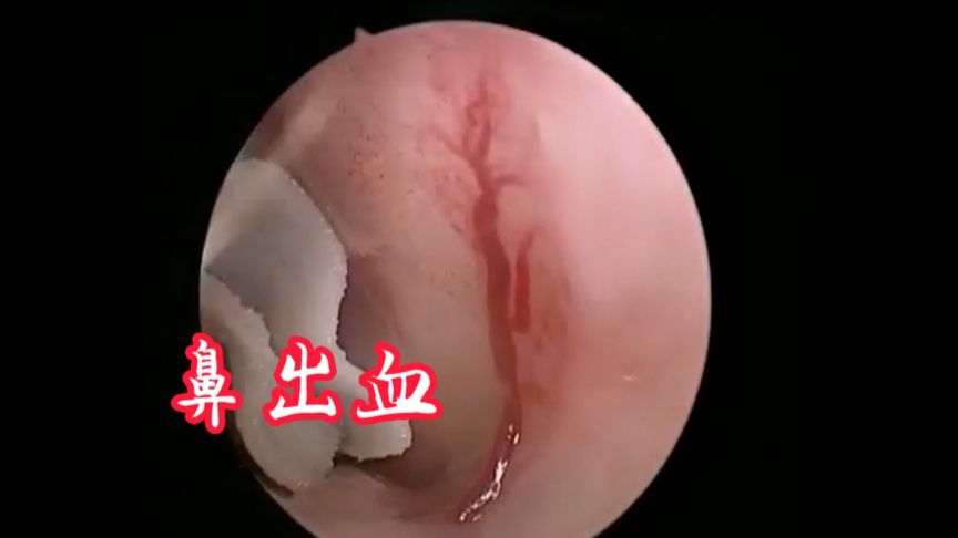 鼻出血治疗(双极电凝止血法)