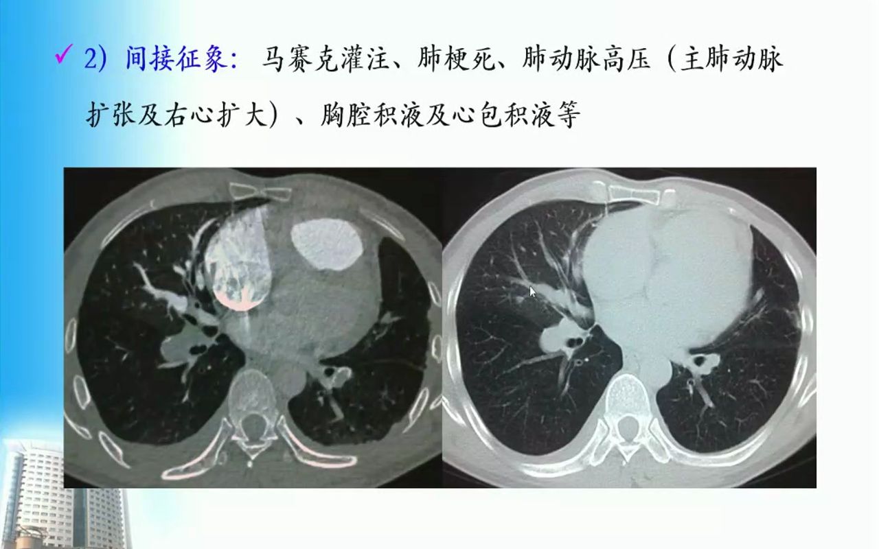 3.急性肺栓塞及主动脉综合征的CTA诊断-急诊影像规培系列