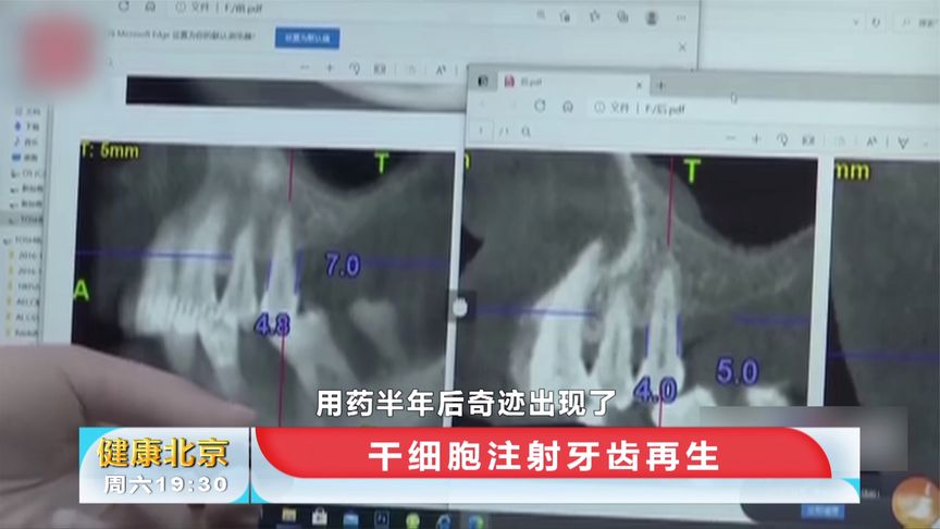 牙齿再生不是梦!女患者报名干细胞再生技术,长出两毫米牙槽骨