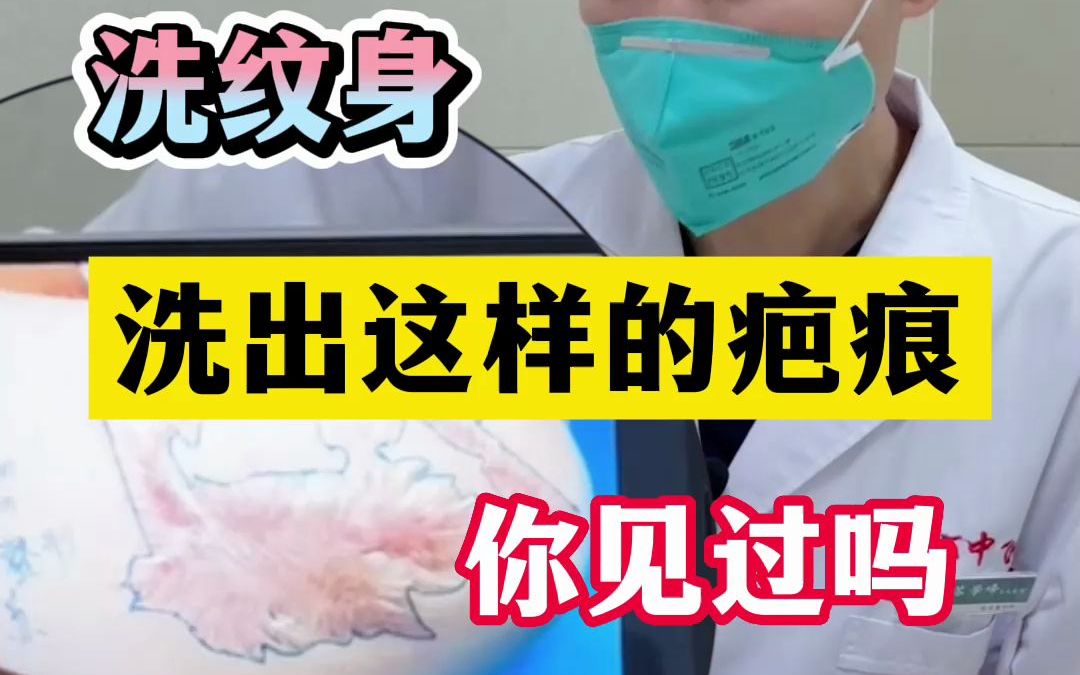 洗纹身居然洗出这么大的疤痕,你见过吗?看完后你还敢随便去洗纹身吗?