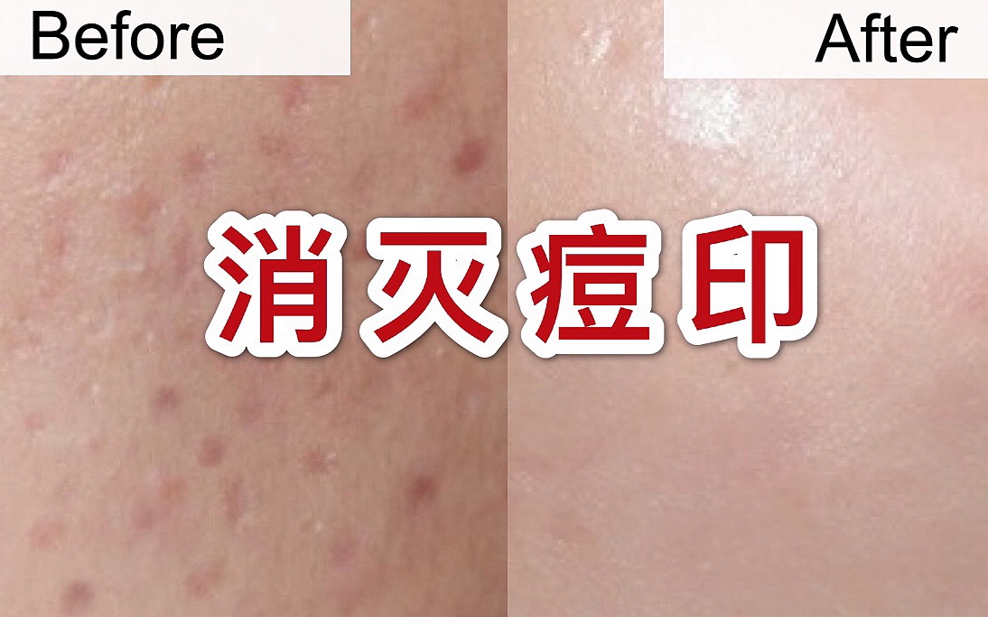 干货!4分钟教你消除痘印痘坑,快速恢复光滑肌