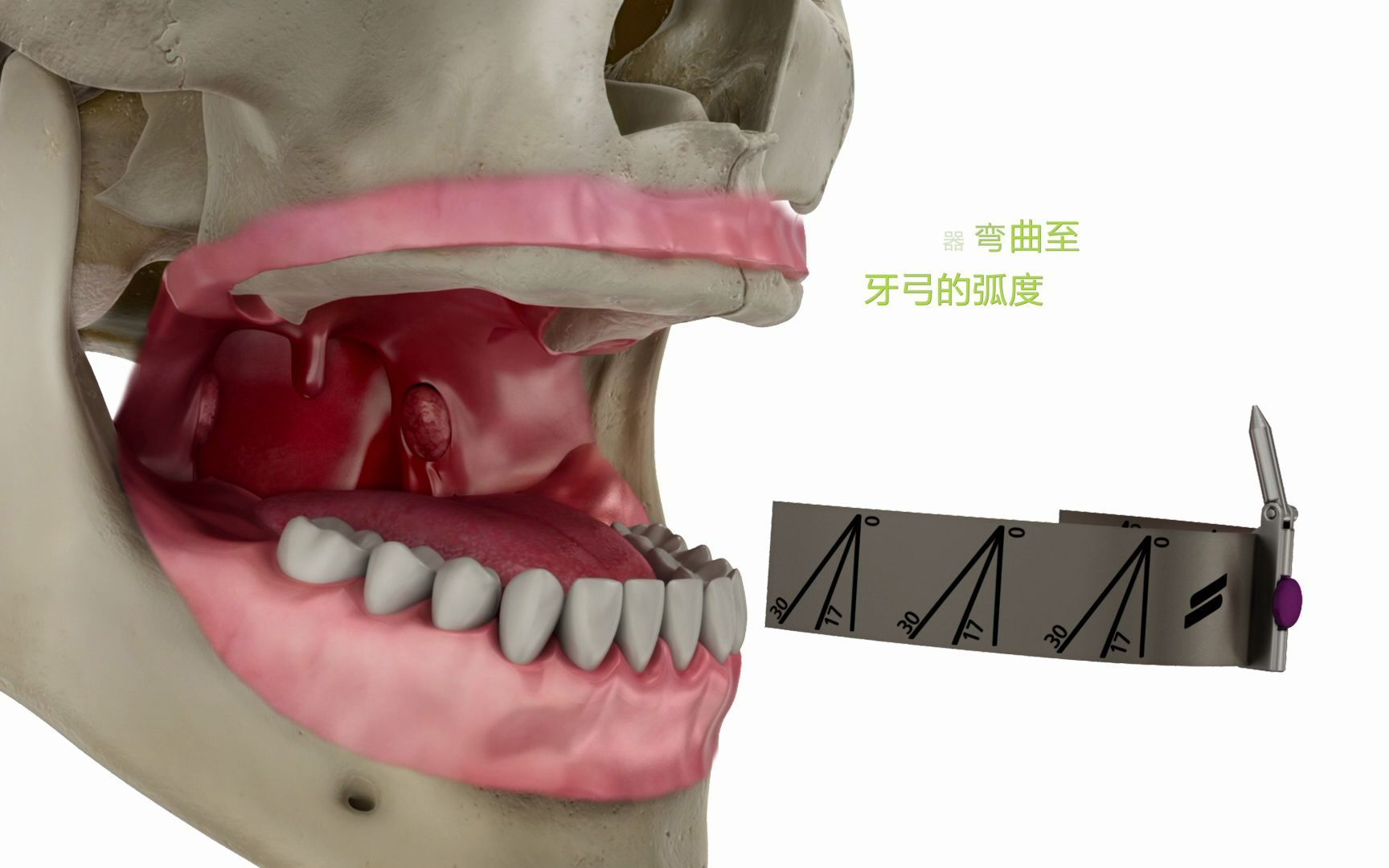 没有牙齿怎么办?别担心,5分钟带你了解无牙颌种植手术全过程